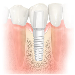 Implants – Ceramics Dental Lab North Miami Beach